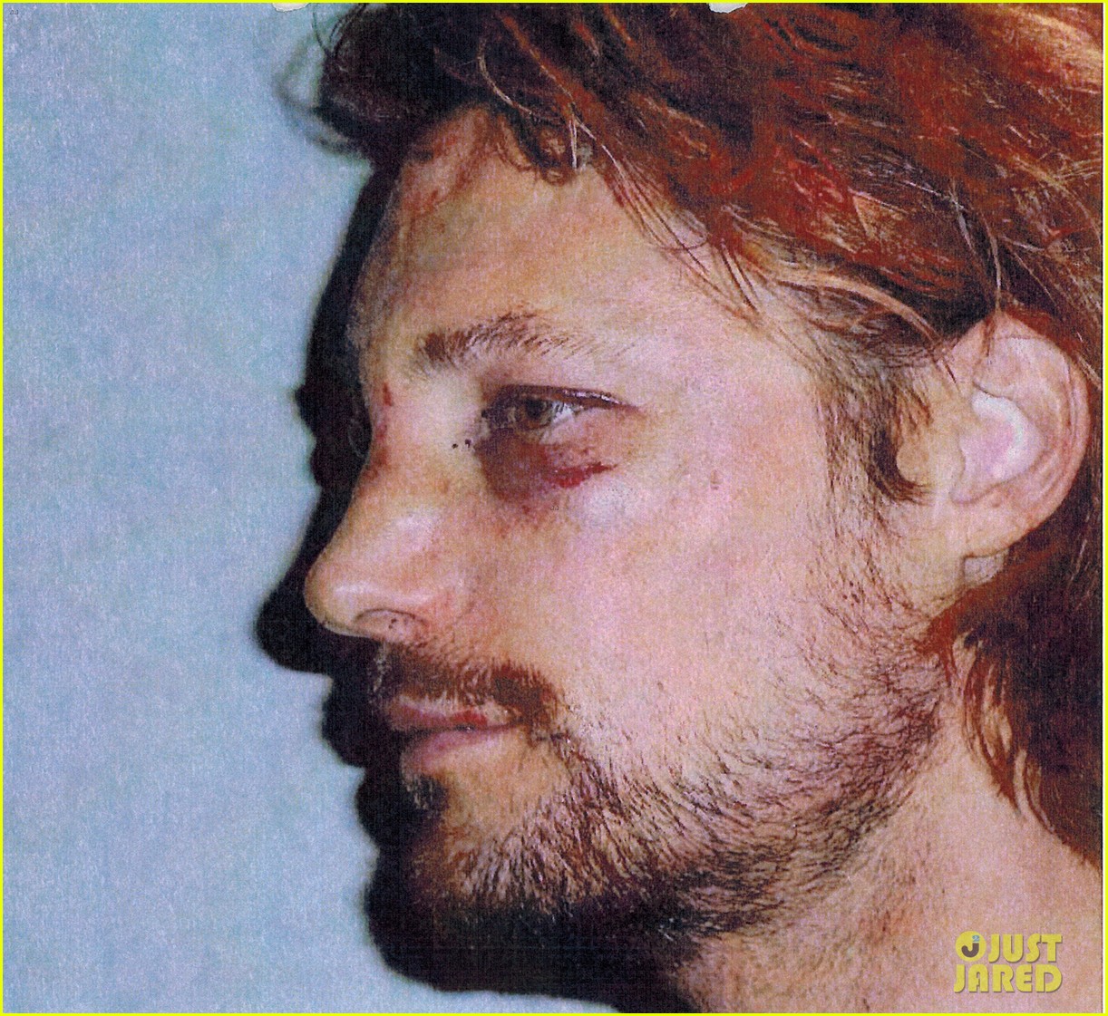 Gabriel Aubry's Black Eye & Bloody Face Revealed - Pics!: Photo 2764614 ...
