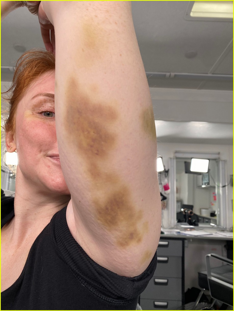 Bryce Dallas Howard Shows Off Her Massive Bruises from 'Jurassic World ...