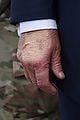 Donald Trump Pictured with Makeup Covering His Right Hand After Doctor ...