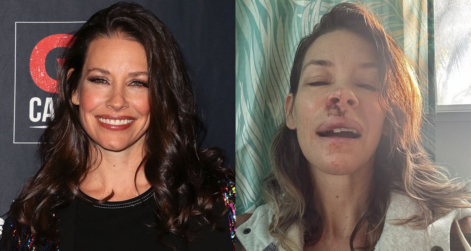 Evangeline Lilly Shows Off Bloody Injuries After Fainting & Hitting ...