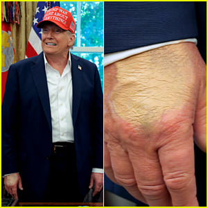 Donald Trump Pictured with Makeup Covering His Right Hand After Doctor’s Recent Comments About ...
